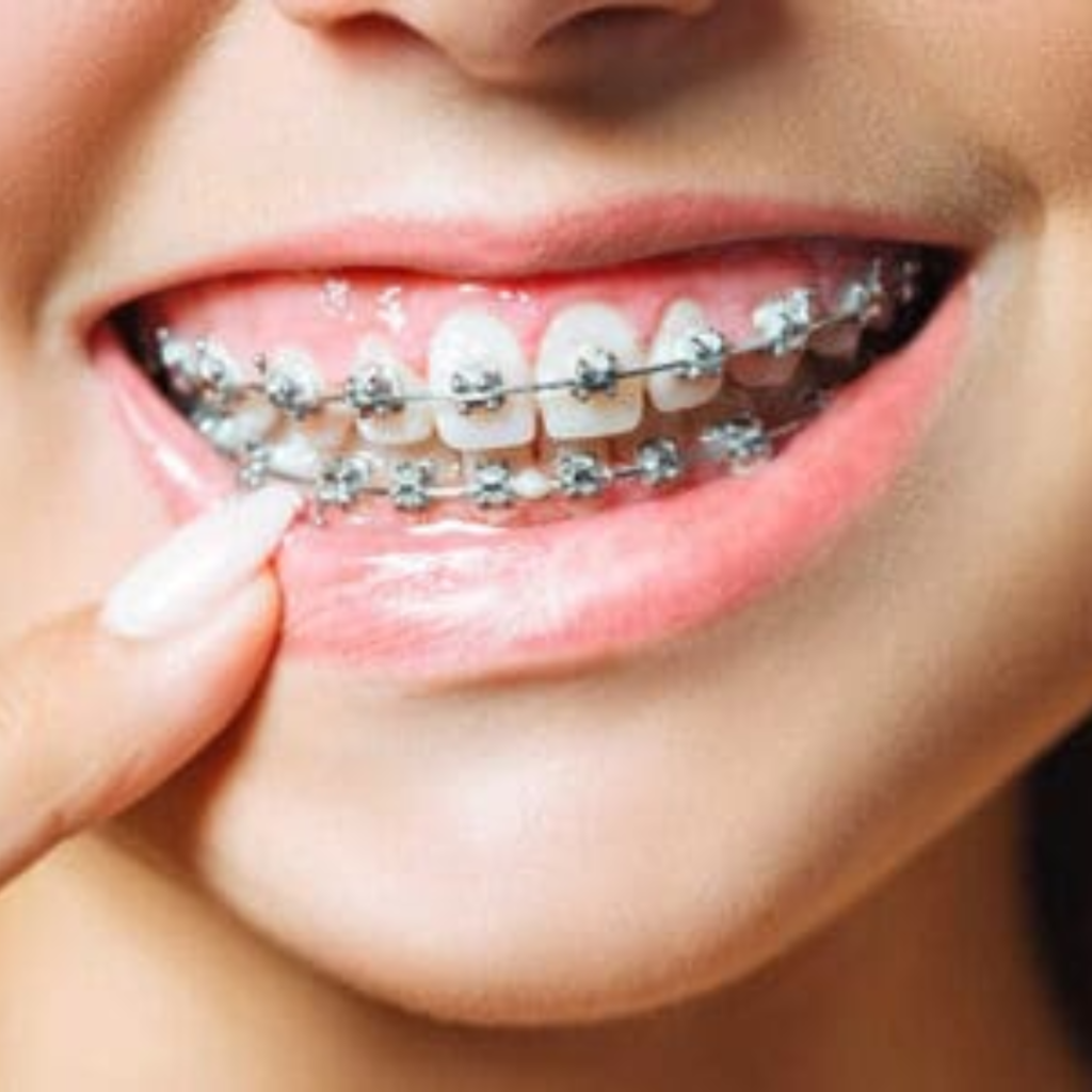 Brackets - Dra Karina Biondi